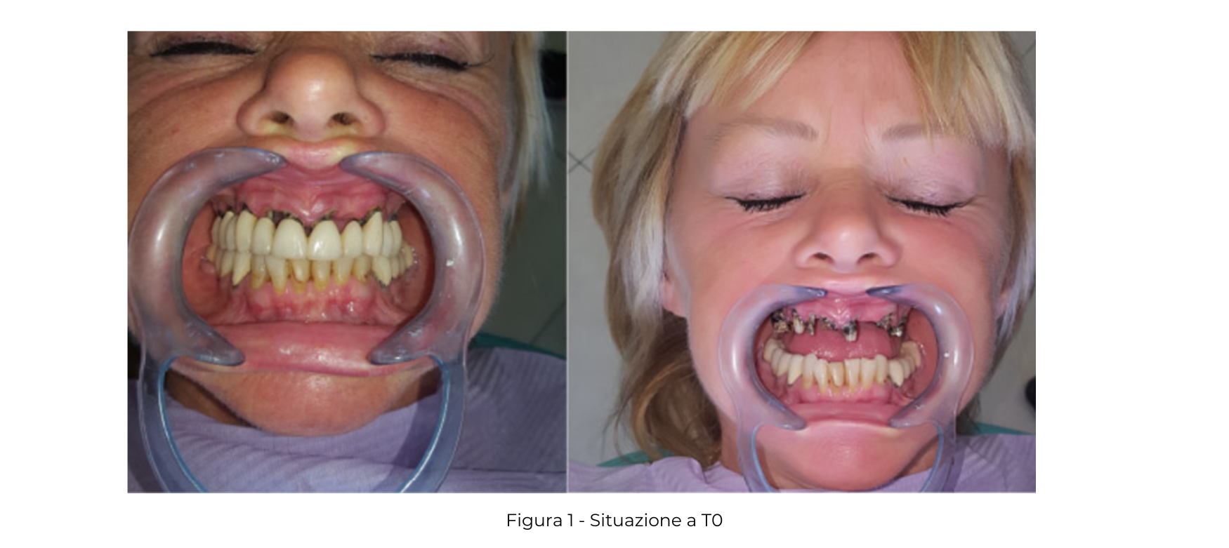 Impianti dentali e occlusione: una storia di successo con Teethan - Teethan